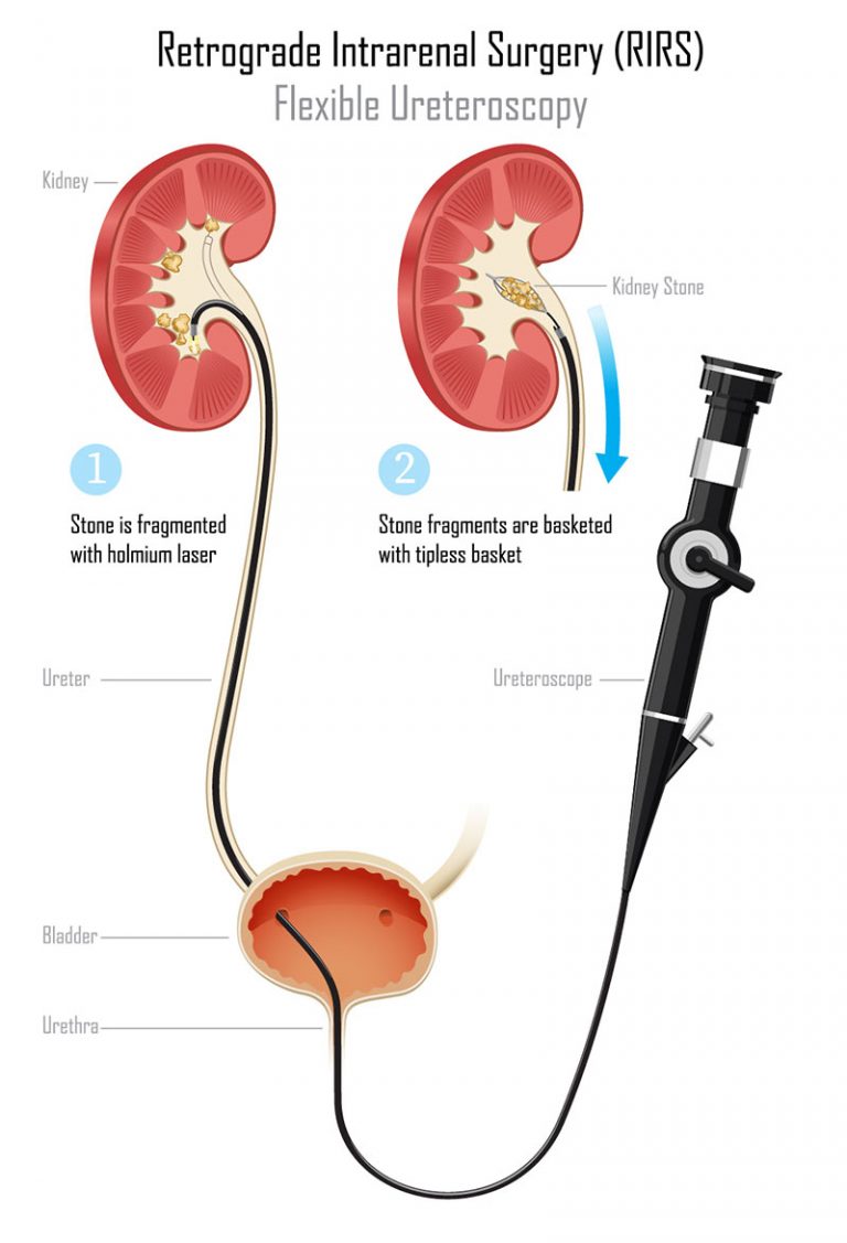 Endoscopic Surgery - Urology